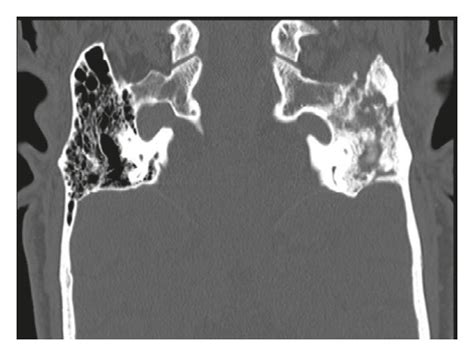 High Resolution Ct Scan Coronal Cut Of The Temporal Bone Total