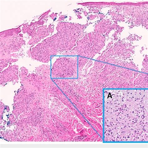 Skin Biopsy Showing A An Area Of Granulomatous Inflammation Of Download Scientific Diagram
