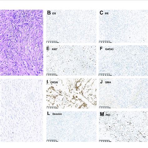 Pathological Examination Showed Spindle Cell Morphology A Hande