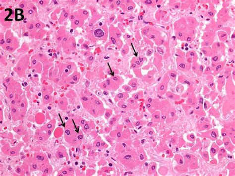 Tumour Cells Exhibited Hyperchromatic Nuclei Irregular “raisindoid