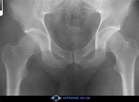 Bilateral Hip Dislocation Orthogate