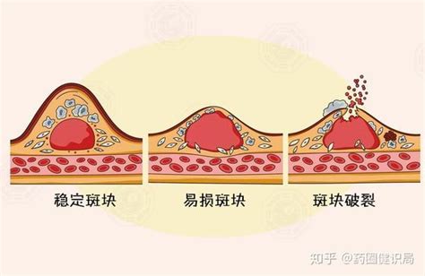 寒潮来袭，谨防心脏“着凉” 知乎