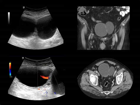 Bladder Diverticulum Ultrasound