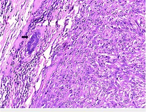 Photomicrograph Of A Well Circumscribed Tumor Composed Of Oval To