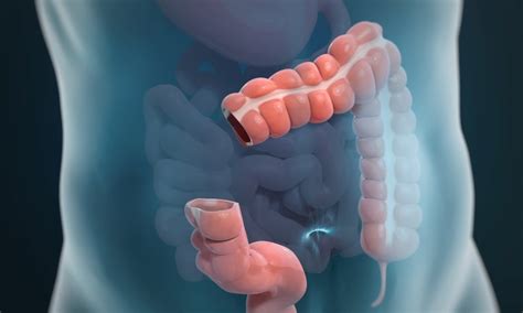 36 Facts About Colectomy