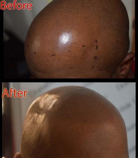 What Tools Are Used For Scalp Micropigmentation Dermmicro Scalp Products