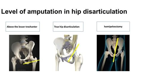 Hip Disarticulation Prosthetic Management Pptx