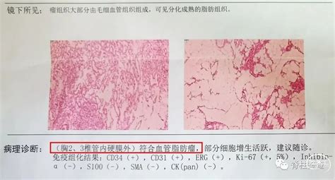 【病例分享】下肢瘫痪产后4天丨完整切除椎管内血管脂肪瘤挽救宝妈脊髓功能 脑医汇 神外资讯 神介资讯
