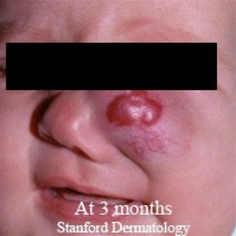 Vascular Malformations Clinic Hemangiomas Dermatology Stanford
