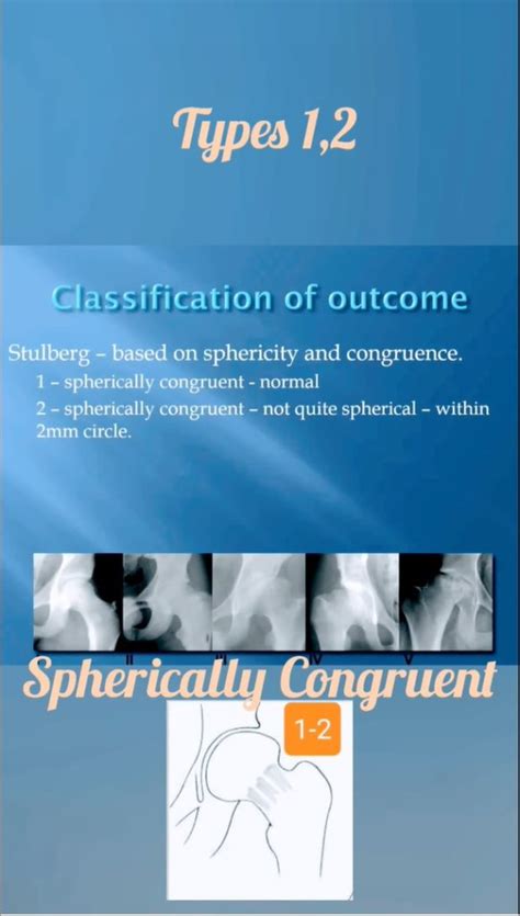 Stulberg Classification In Perthes Disease —
