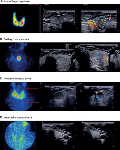 Hyperthyroidism Aetiology Pathogenesis Diagnosis Management