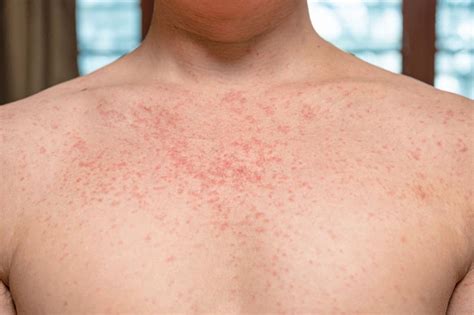 How Long Does It Take To Cure Syphilis Symptoms And Causes