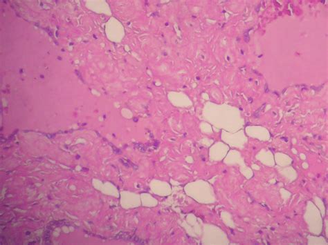 Thyroid Amyloidosis Interstitial Tissue Expanded By Abundant Amyloid Download Scientific