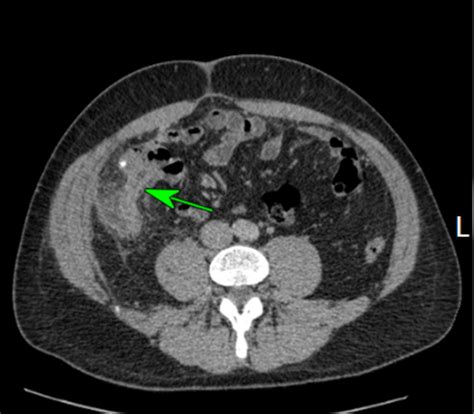 Diverticulitis And Diverticulosis Of The Appendix A Case Series Abstract Europe Pmc