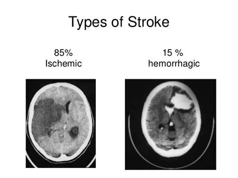 Management Of Stroke