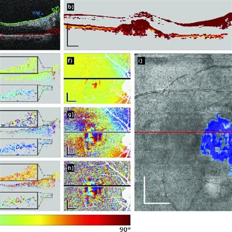 Ps Oct Data Processing Steps To Segment Subretinal Fibrosis