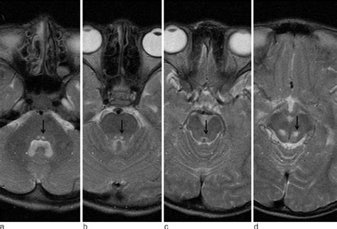 Internuclear Ophthalmoplegia Mri