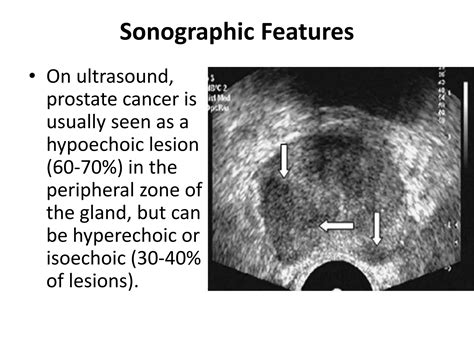 Prostate Ultrasound Basic Pptx