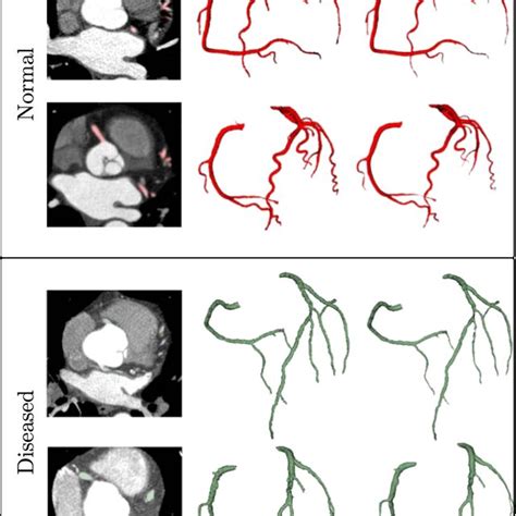 Samples Of Annotated Data Showing A An Annotated Slice Of The Ctca Download Scientific