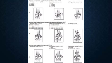 Upper Extremity Fracture Principles Ppt
