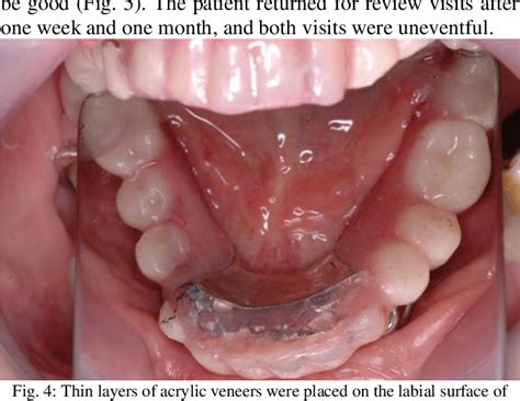 Figure 4 From Restoring Occlusal Vertical Dimension Of Kennedy Class I Partially Edentulous