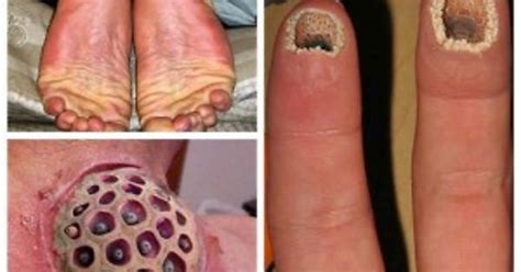 Trypo Whats So Scary About A Couple Lil Holes Imgur