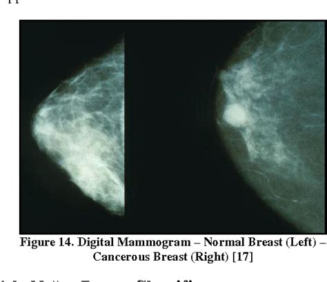 Figure 14 From Diagnosis Of Breast Cancer Using Decision Tree Data