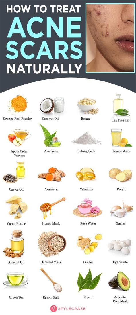 How To Get Rid Of Back Acne Using Home Remedies Artofit