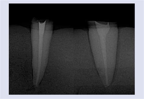 Radiographs Of Root Canal Filled With Ch Download Scientific Diagram
