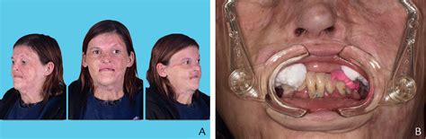 Figure 1 From Integrating Hinge Axis Approximation And The Virtual