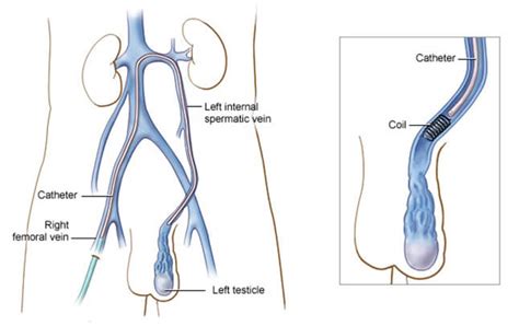 Varicocele Embolization Treatment In Hyderabad Dr Suresh Giragani