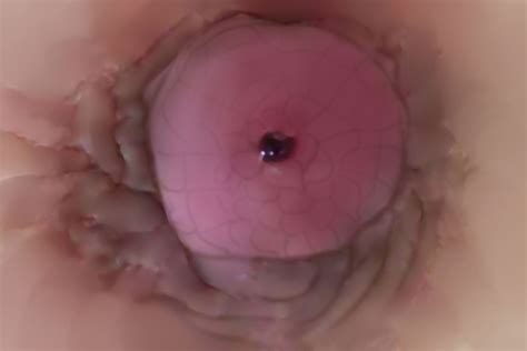 乳腺癌外观图片大全