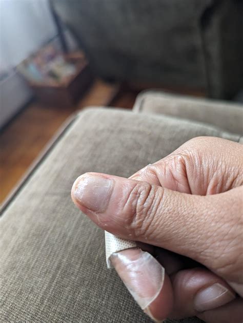 It Worked Habit Tic Nail Deformity Rcalmhands