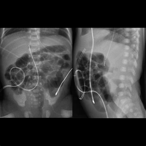Premature Newborn After PICC Placement Pediatric Radiology Case Pediatric Imaging