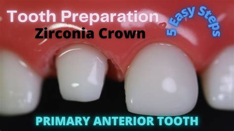 Tooth Preparation For Anterior Zirconia Crown🟡signature Crowns🔴