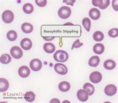 Basophilic Stippling Learnhaem Haematology Made Simple