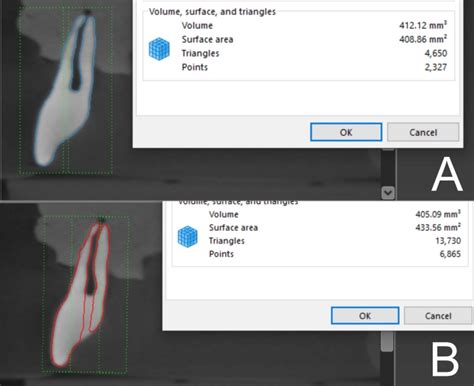 Dynamic Navigation In Endodontics Guided Access Cavity Preparation By Means Of A Miniaturized
