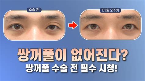 무쌍수술이란 무엇인가요 압구정김원장 Youtube