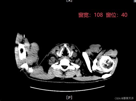 Dicom医学影像应用篇——窗宽窗位概念、原理及实现详解骨窗 Csdn博客