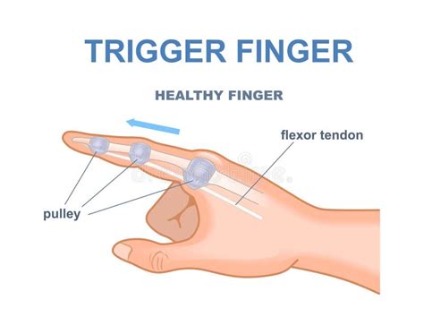 Trigger Finger Vector Concept Stock Illustration Illustration Of