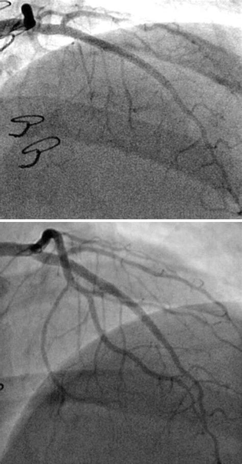 Intimal Thickening In Cardiac Allograft Vasculopathy And Intravascular