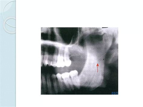 Technique Of Mandibular Anesthesia Pptx