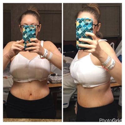 34c Breast Reduction