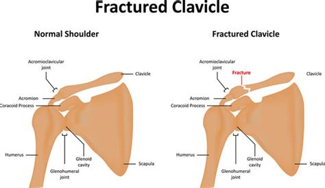 Coracoid Process Of Humerus