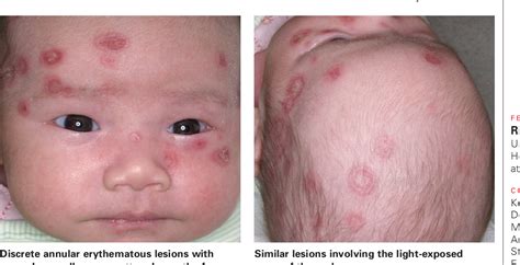 Figure 2 From Annular Rash On A Newborn Semantic Scholar