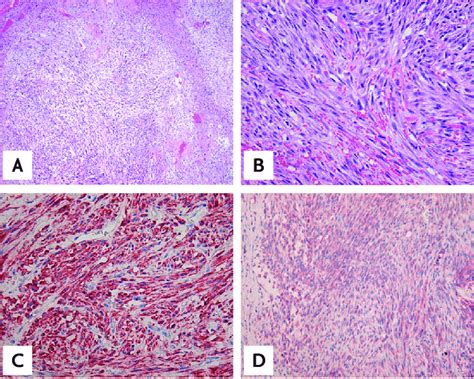 Spindle Cells Histology At Harold Walters Blog
