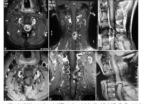 Figure 1 From Primary Spinal Extraosseous Cervical Chondroma In An Adult Semantic Scholar