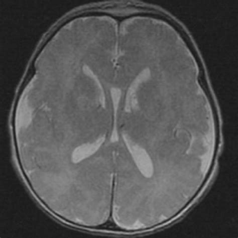 Neuroanatomy Glossary Zellweger Syndrome Ditki Medical And Biological