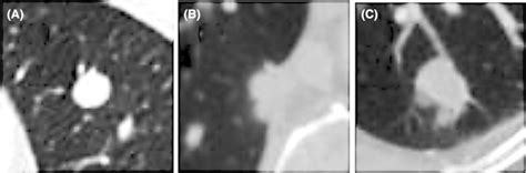 Illustration Of Lung Nodules With Diverse Locale And Sizes A Download Scientific Diagram