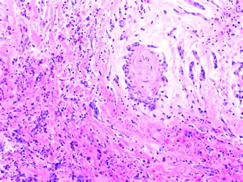 Myxoma With Myxoid Stroma And Tumor Cells Forming Linear Aggregates And Download Scientific